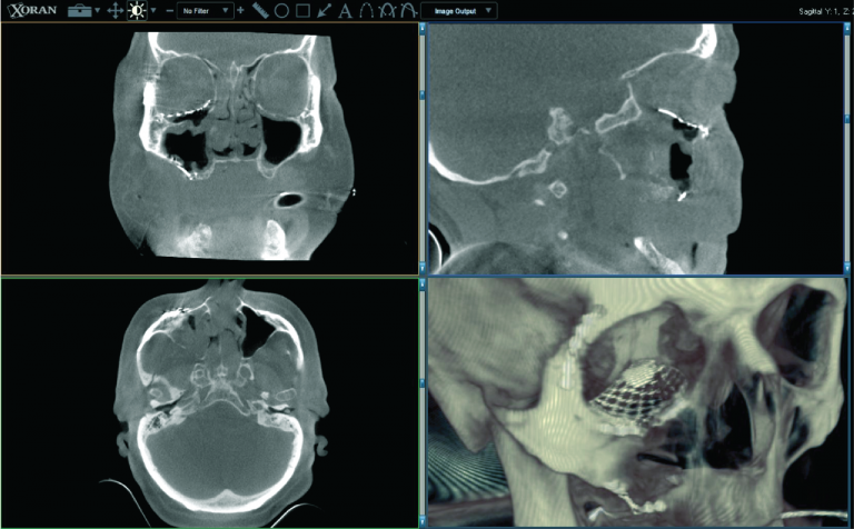 xCAT XL - Mobile CT Scanner for ICU and Operating Rooms
