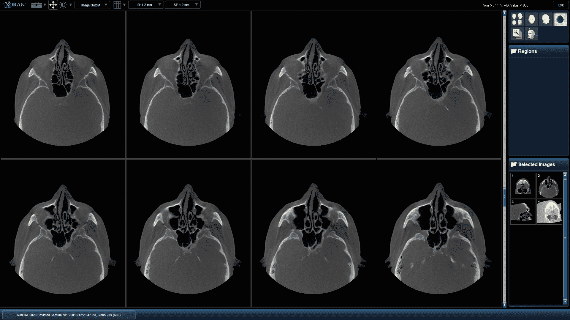 MiniCAT 2020 CT Scanner for ENT & Allergy Physicians