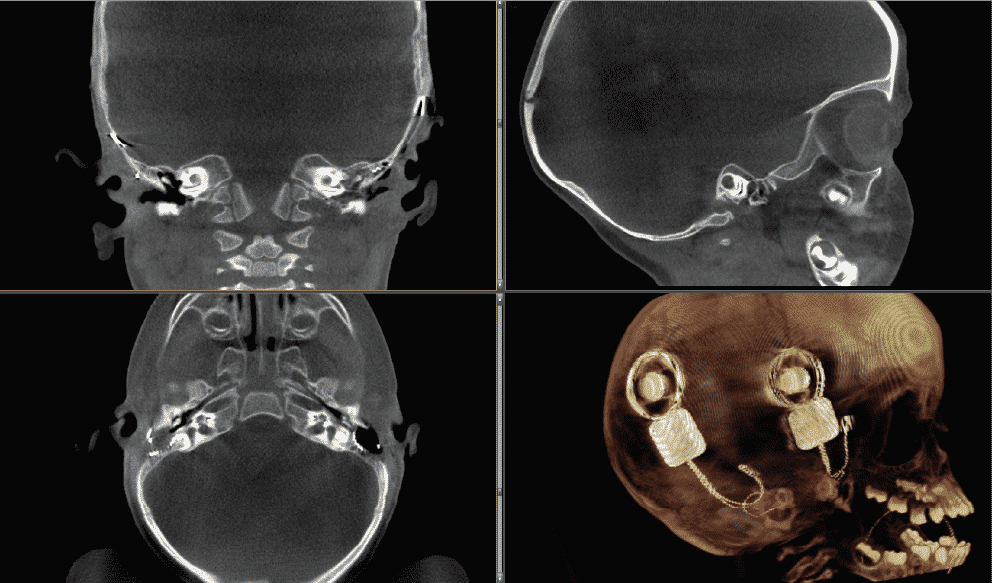 xCAT IQ Ultra-Compact Cone Beam CT Imaging Solution