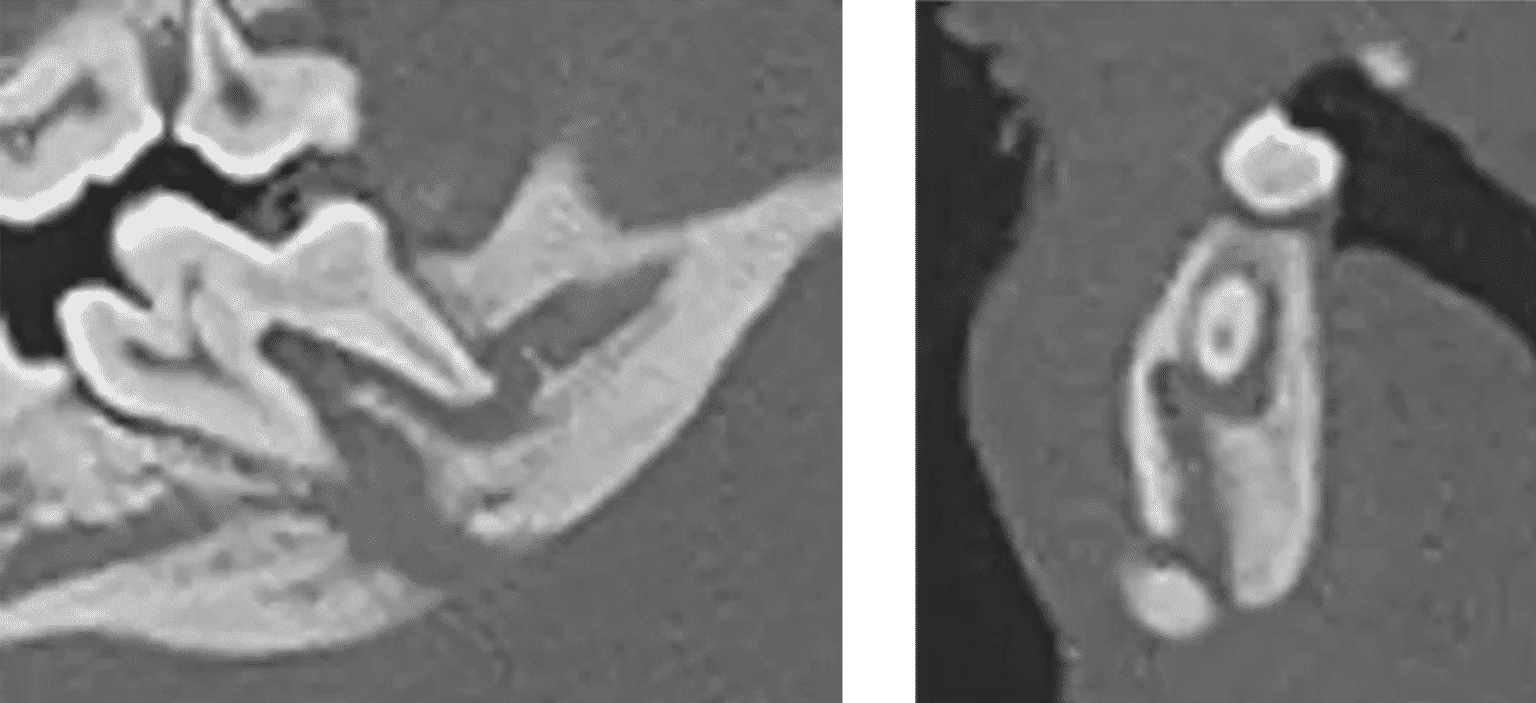 3D Visualization of Draining Tracts - Xoran Technologies LLC