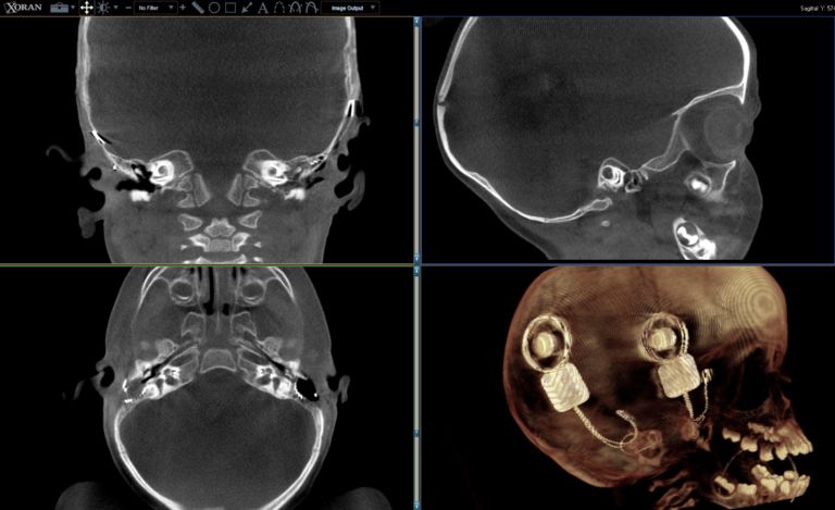 xCAT XL - Mobile CT Scanner for ICU and Operating Rooms