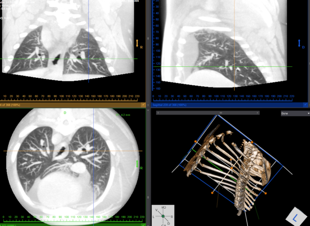 vTRON imaging enables change in surgical plan