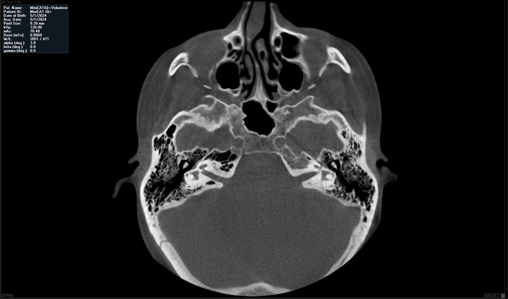 Next Generation MiniCAT - CT Scanner for ENT Professionals